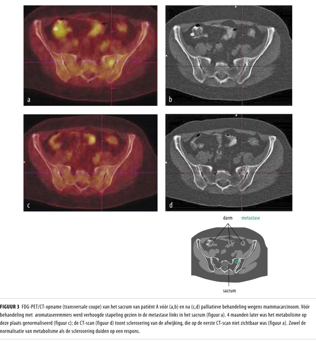 FDG-PET/CT bij stadiëring van mammacarcinoom | NTvG