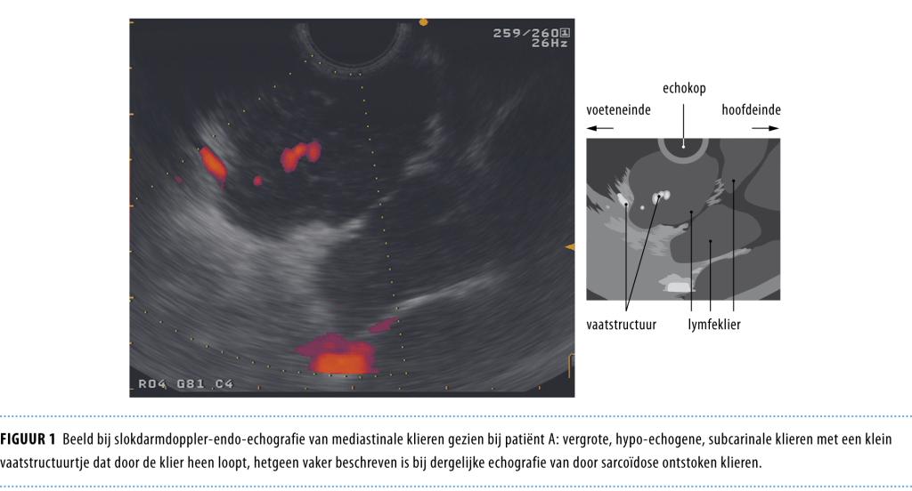 Gemetastaseerd testiscarcinoom of sarcoïdose | NTvG