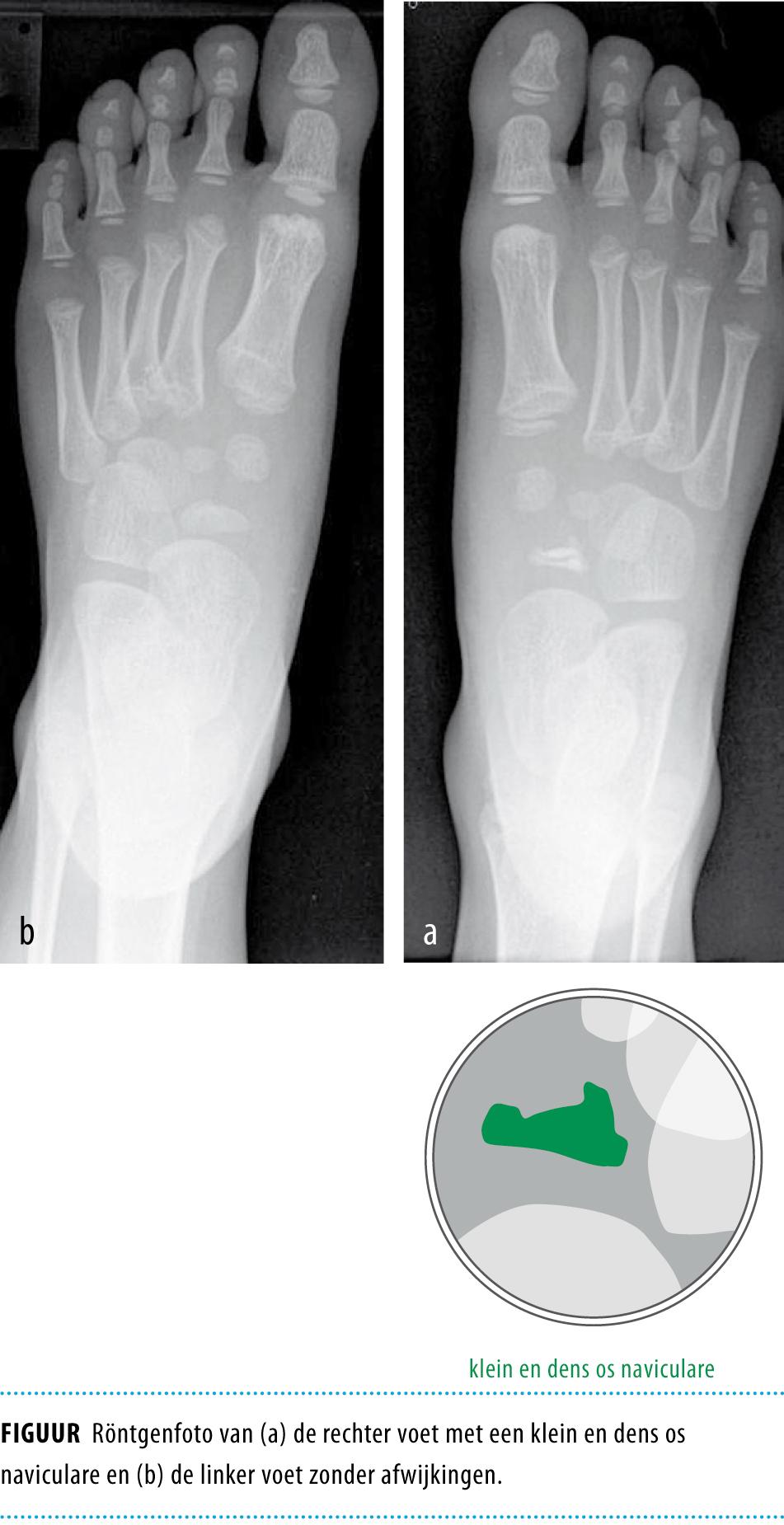 Een jongen met een pijnlijke voet | NTVG