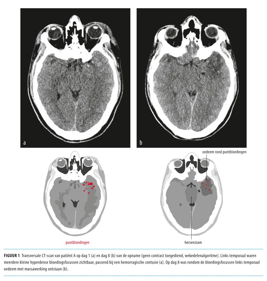 Decompressieve craniëctomie | NTvG
