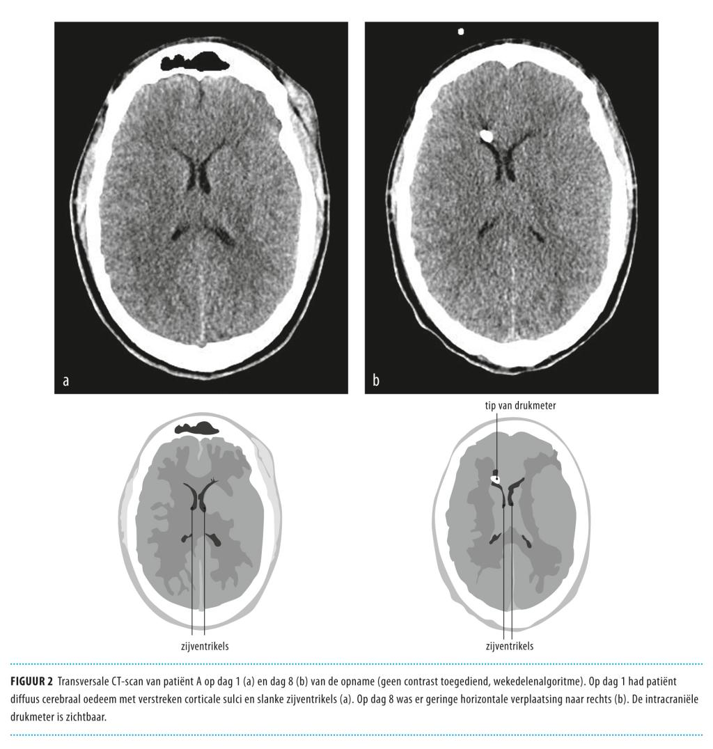 Decompressieve craniëctomie | NTvG
