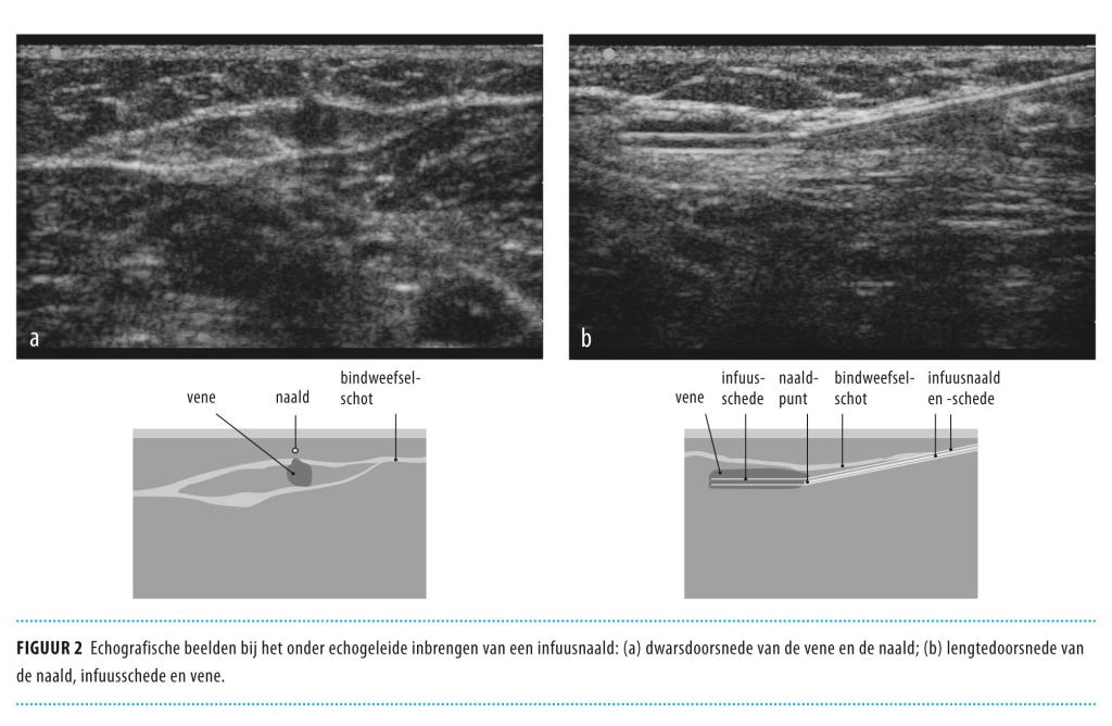 Echografische geleiding bij het plaatsen van een moeilijk perifeer ...