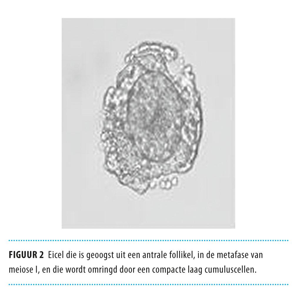 In-vitromaturatie (IVM) van humane eicellen | NTvG