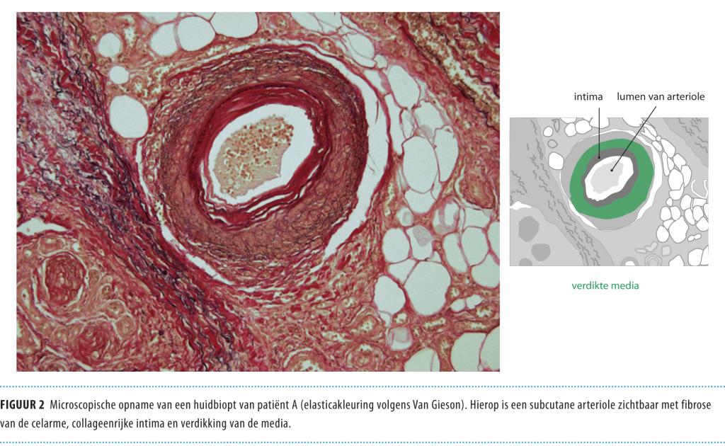 Een zeer pijnlijk ulcus op het onderbeen | NTVG