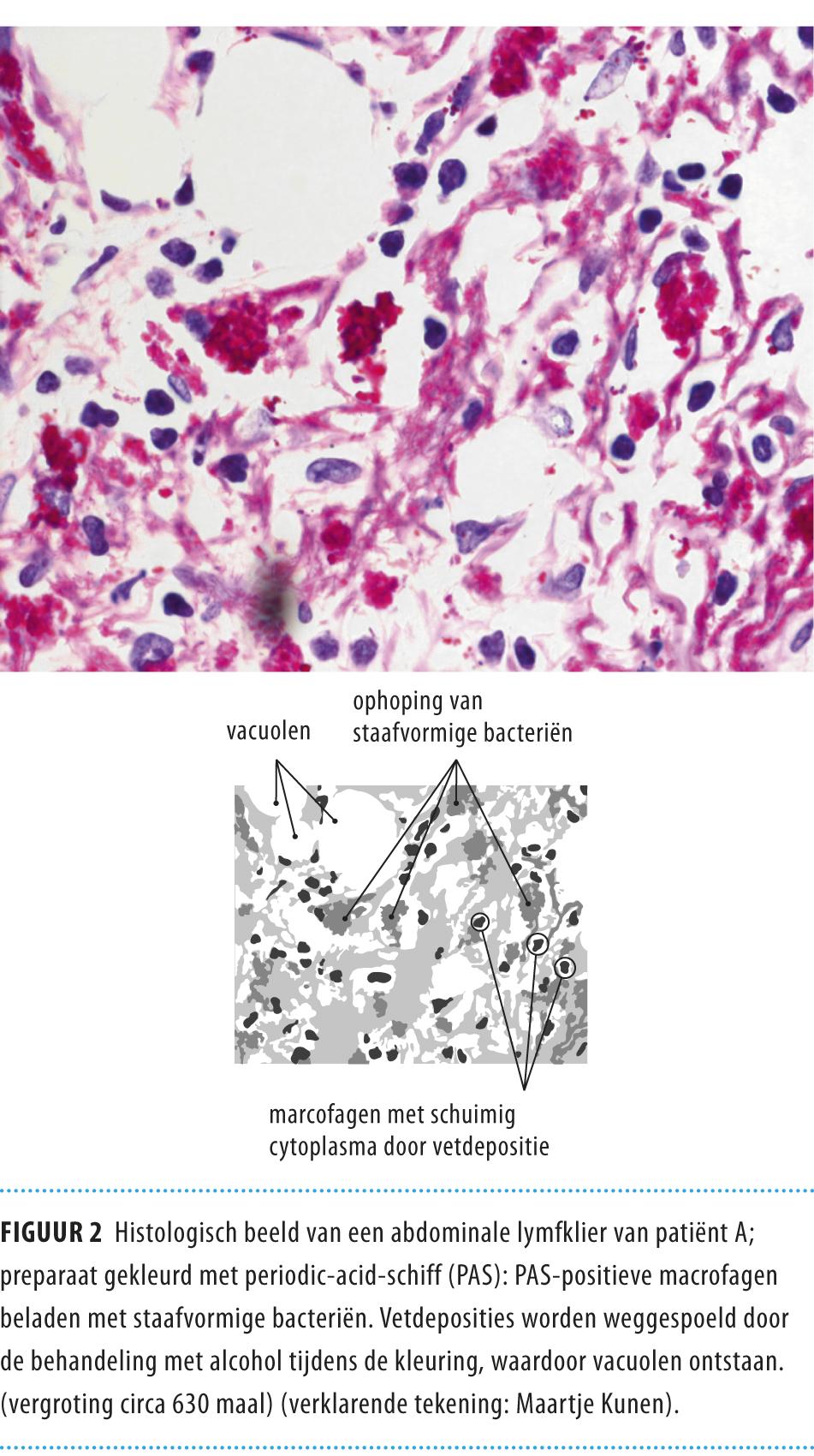 Onbegrepen lymfadenopathie: ziekte van Whipple | NTvG