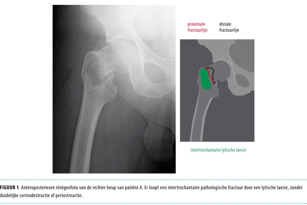 Een pathologische proximale femurfractuur: denk ook aan een primaire ...