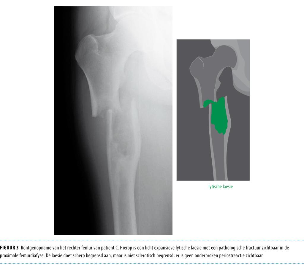 Een pathologische proximale femurfractuur: denk ook aan een primaire ...