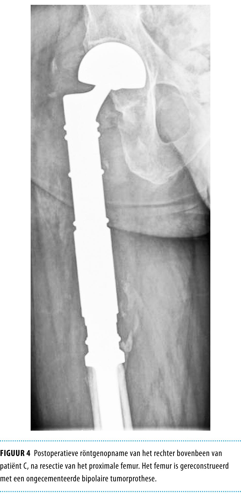 Een pathologische proximale femurfractuur: denk ook aan een primaire ...