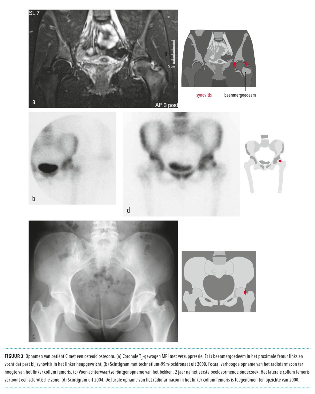 Heupklachten worden soms veroorzaakt door een osteoïd osteoom | NTvG