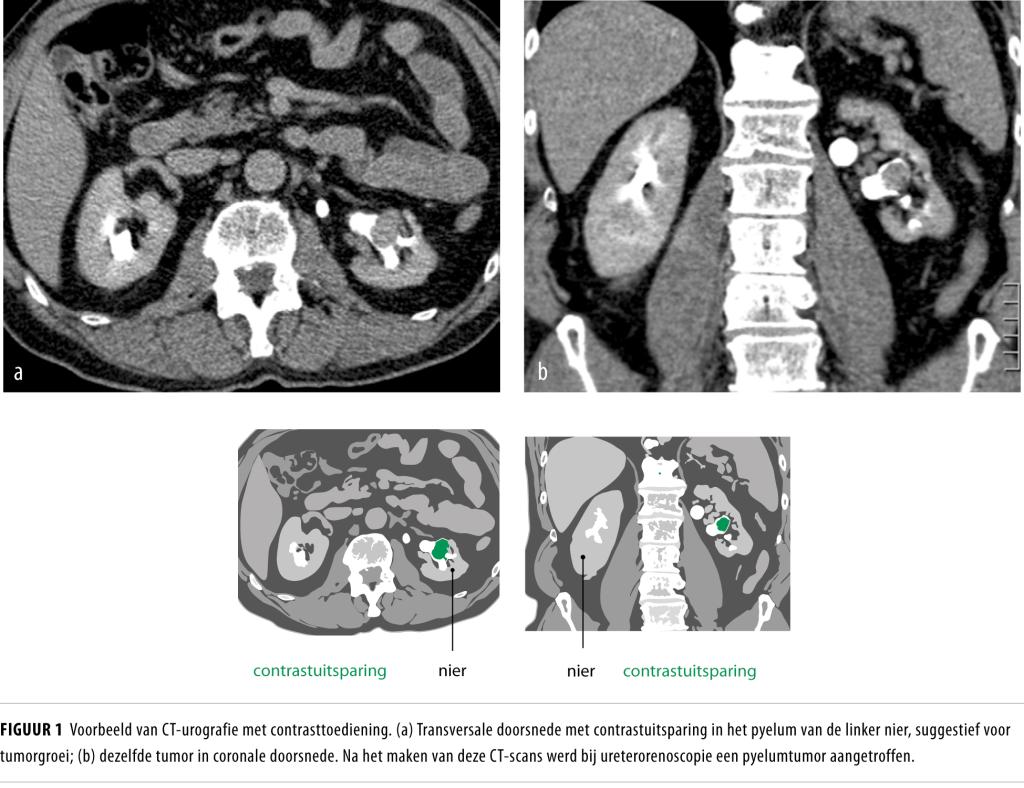 Urotheelcelcarcinoom in de hoge urinewegen | NTVG