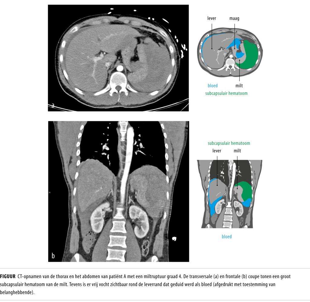Een atraumatische spontane miltruptuur bij een jonge man | NTvG