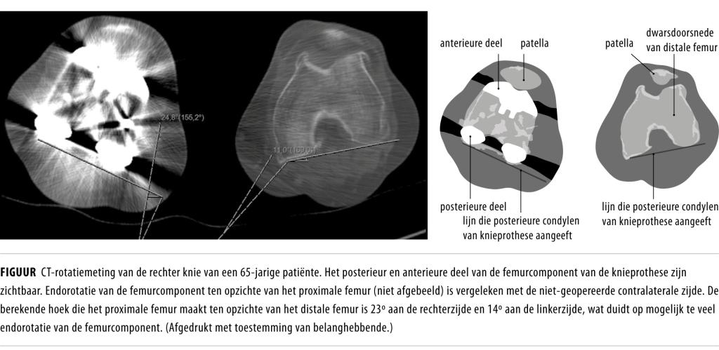 Pijn na primaire totale knieprothese | NTVG