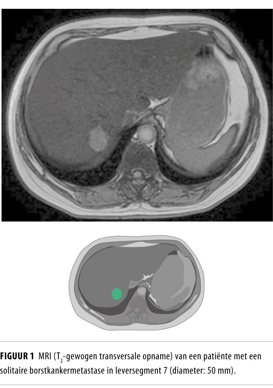 Resectie van levermetastasen bij borstkanker | NTvG