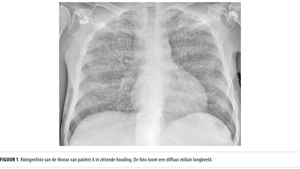 Fatale tuberculose tijdens gebruik van ruxolitinib | NTvG