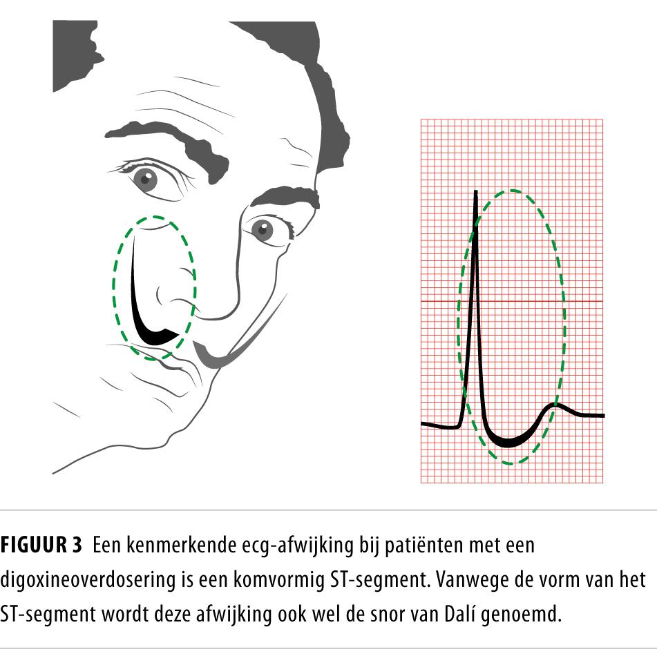 Een zuigeling met een digoxine-intoxicatie | NTvG