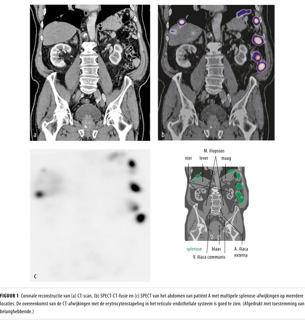 Abdominale splenose | NTVG