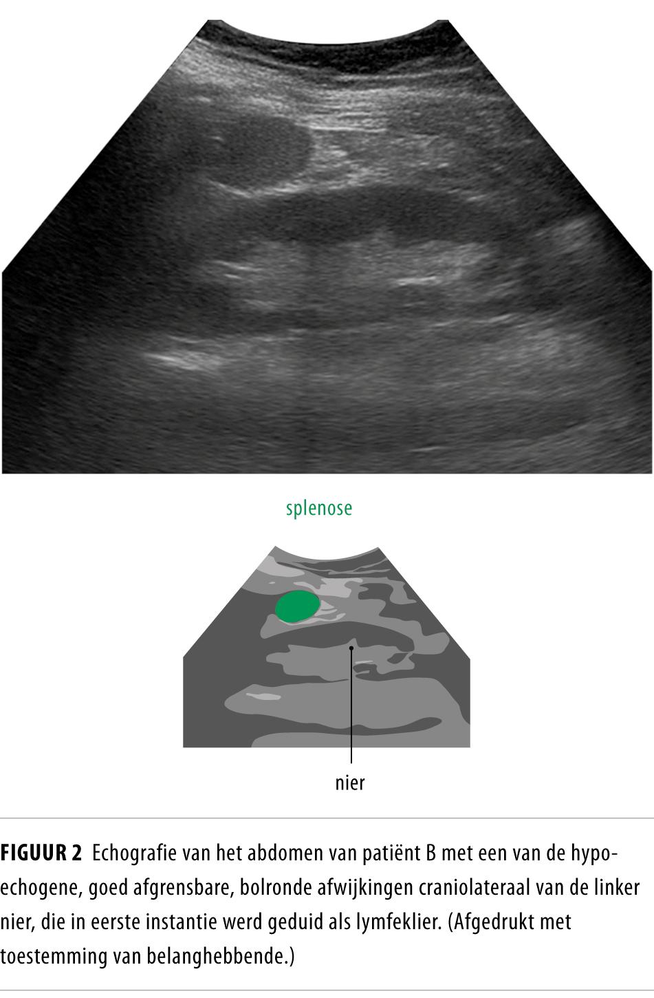 Abdominale splenose | NTVG
