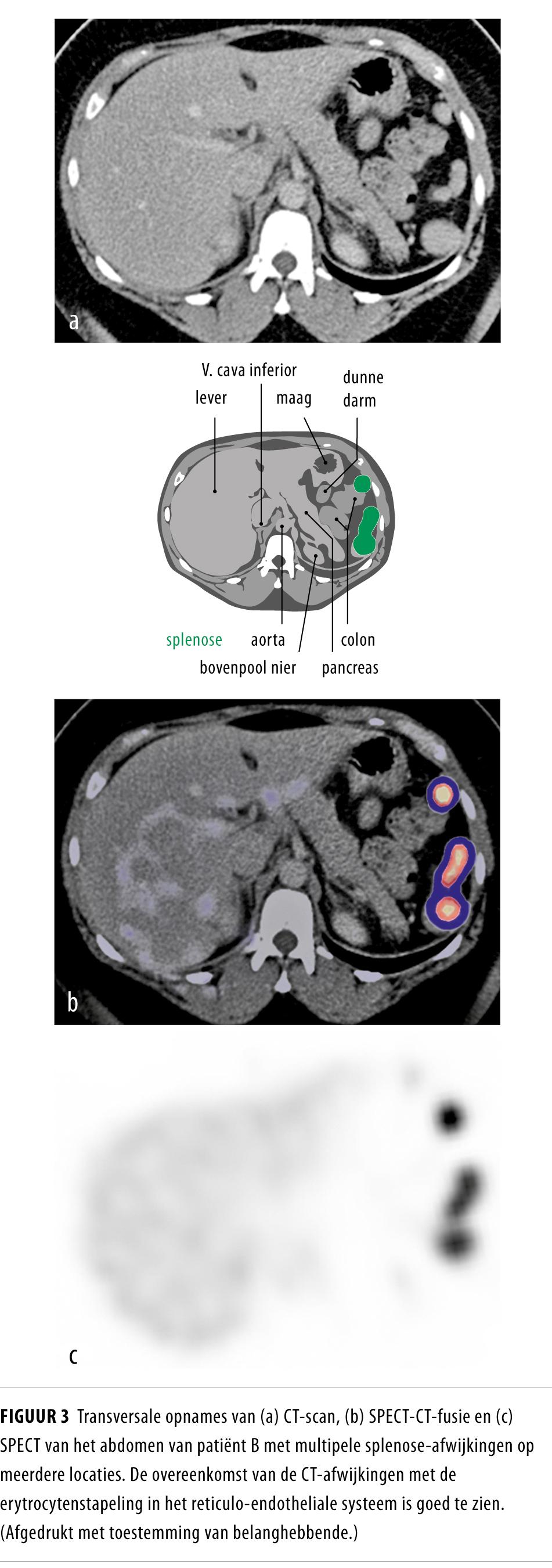 Abdominale splenose | NTVG
