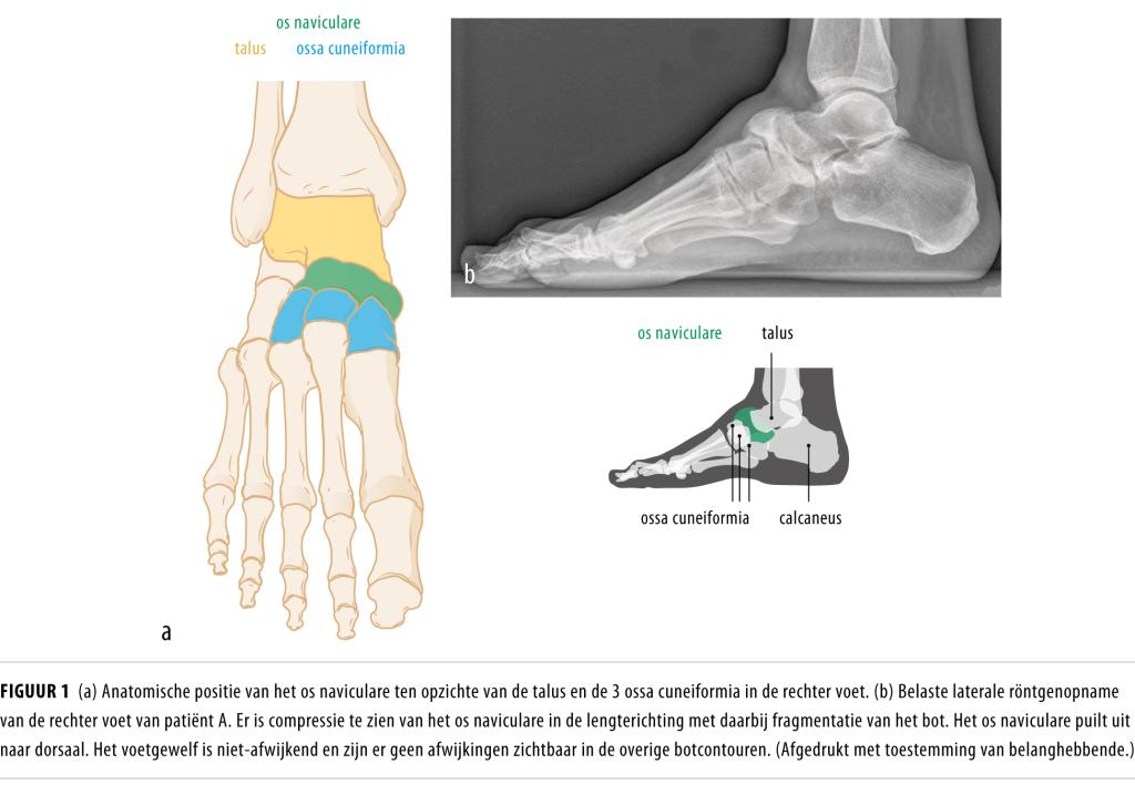 Ziekte van Müller-Weiss | NTVG