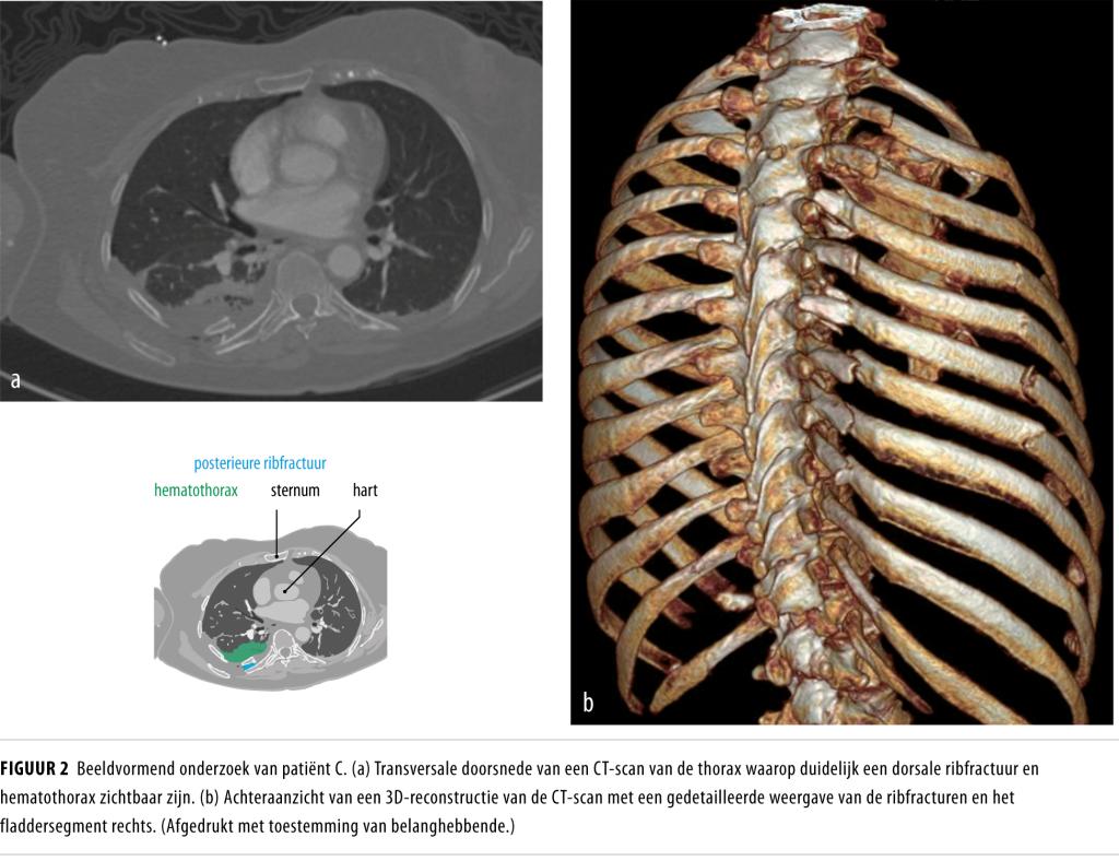 De oudere patiënt met multipele ribfracturen | NTvG