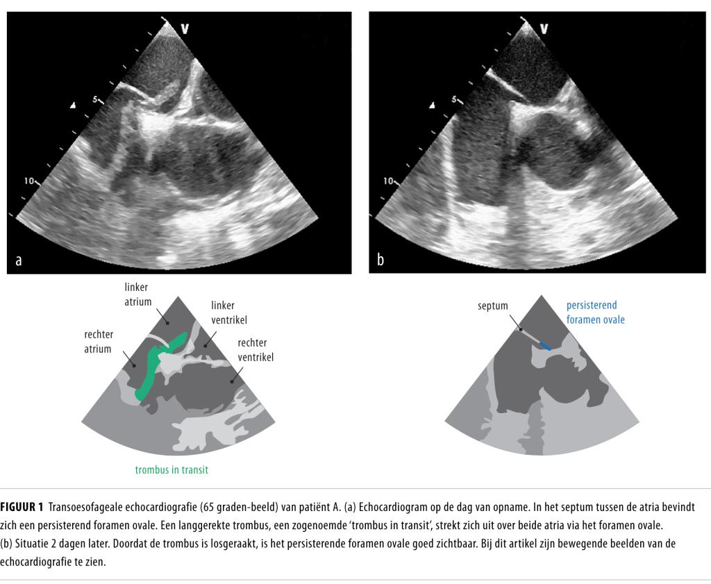 Een trombus in een persisterend foramen ovale | NTvG