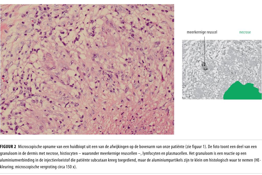 Cutane ulcererende noduli na jarenlang immunotherapie | NTvG