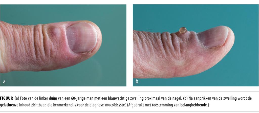 Een man met een bobbel op zijn duim | NTVG