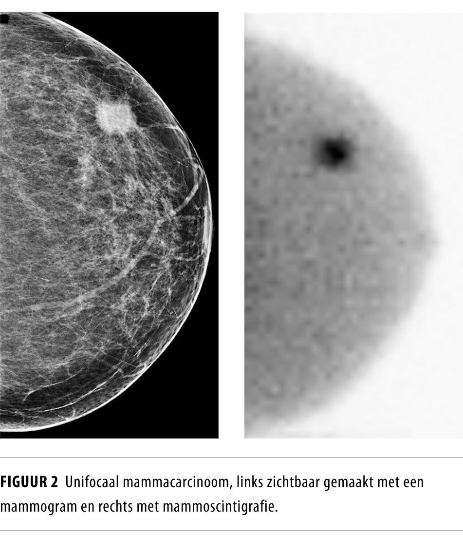 ‘Breast-specific gamma imaging’ bij borstkanker | NTvG