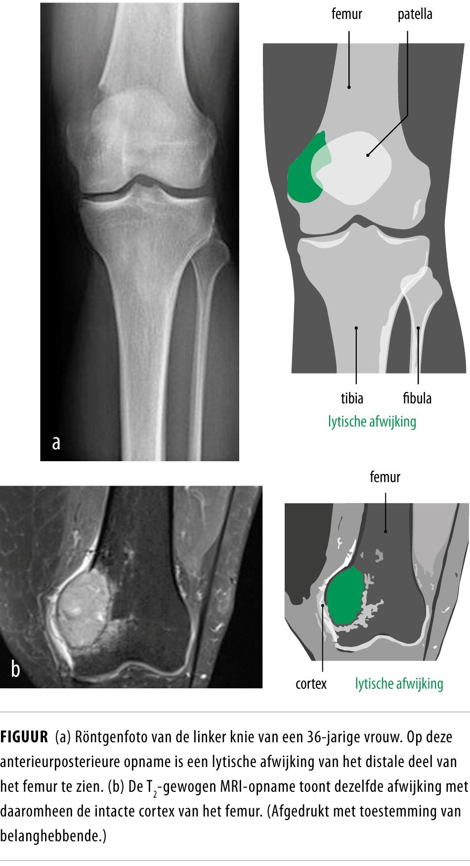 Een hardloopster met een pijnlijke knie | NTVG