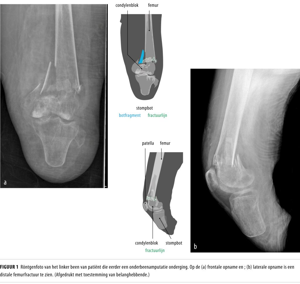 Distale femurfractuur bij vrouw met onderbeenprothese | NTvG