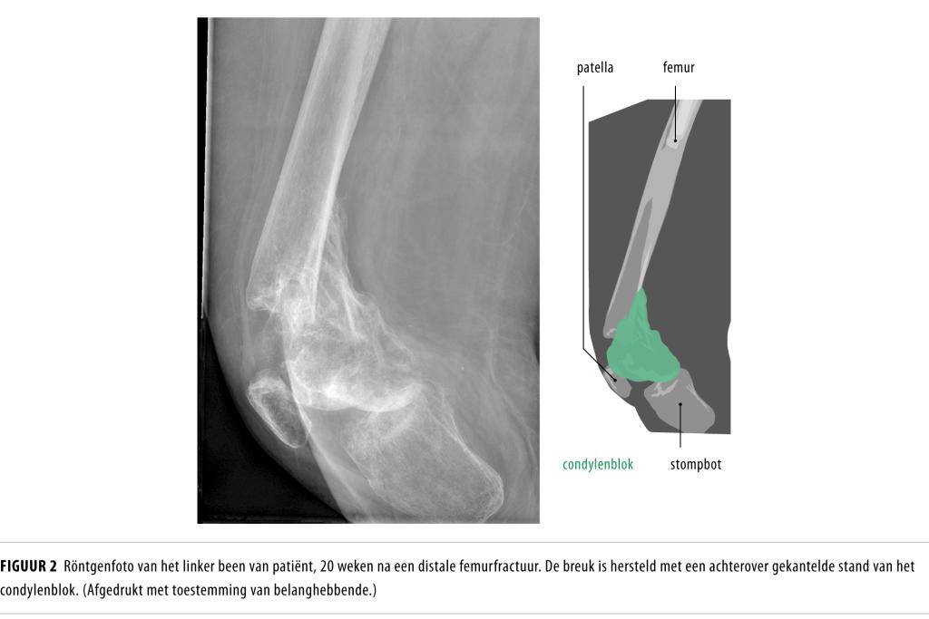 Distale femurfractuur bij vrouw met onderbeenprothese | NTvG