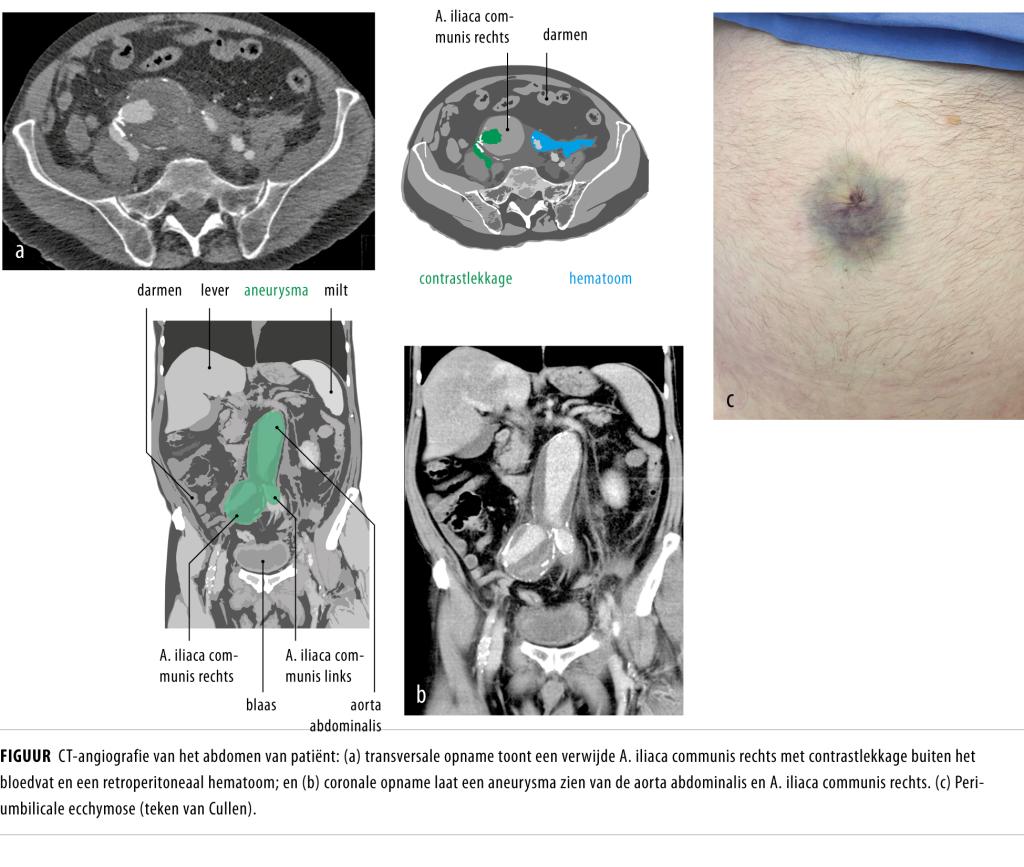 Een man met buikpijn en daarna een navelhematoom | NTvG