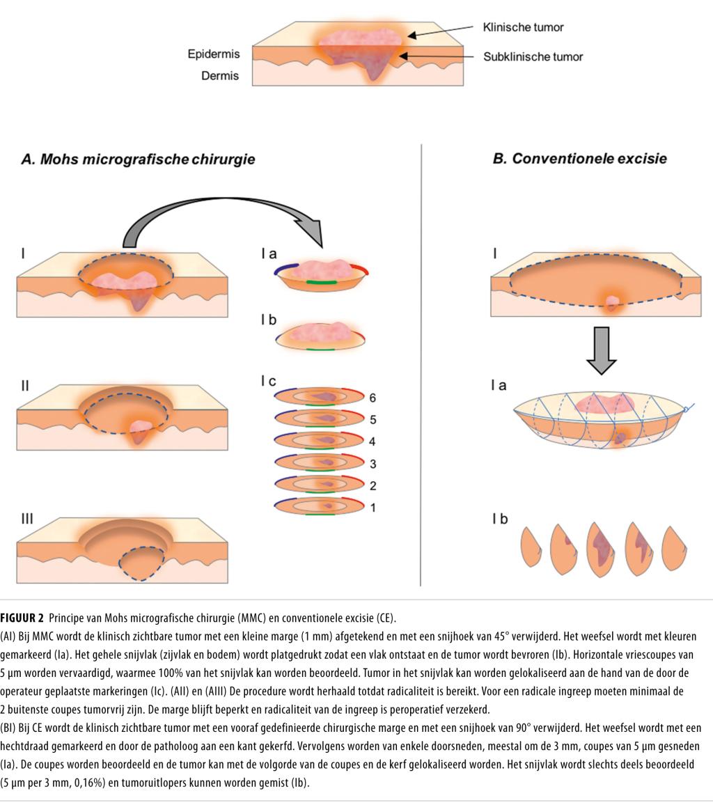 Radicale behandeling van basaalcelcarcinoom | NTvG