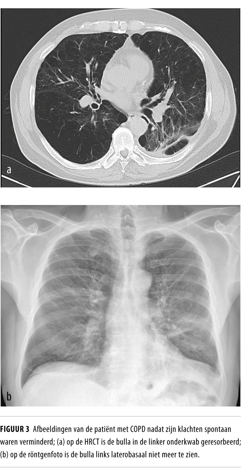 Spontane klinische verbetering bij een COPD-patiënt | NTVG