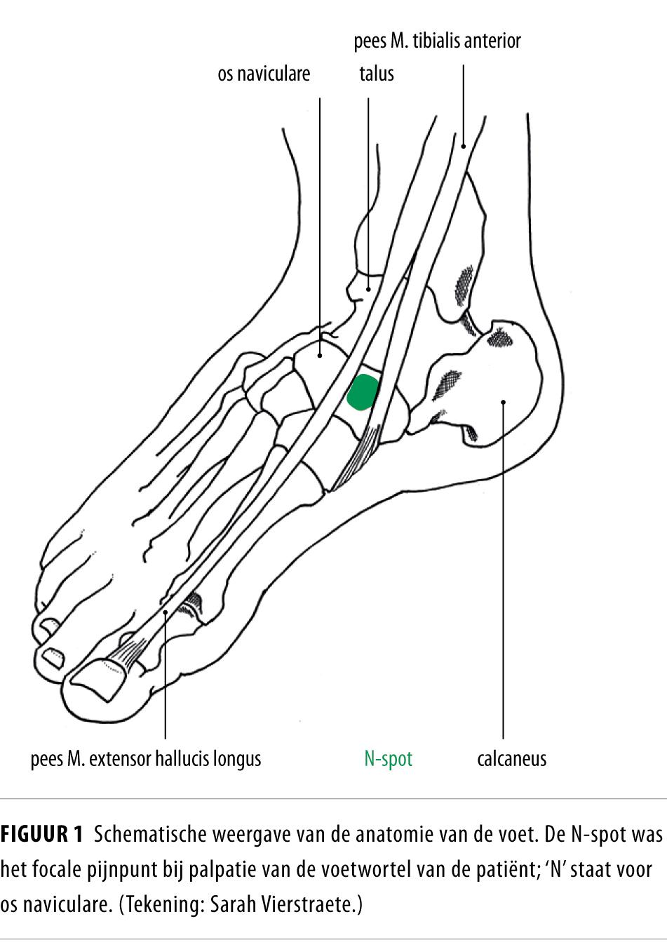 Stressfractuur of osteochondraal letsel van het os naviculare? | NTVG