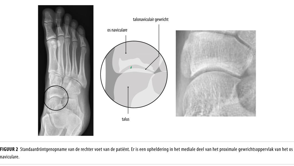Stressfractuur of osteochondraal letsel van het os naviculare? | NTVG