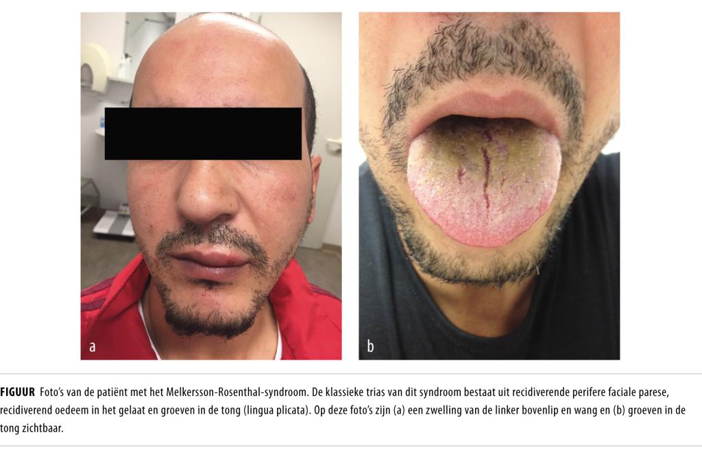 Een patiënt met het syndroom van Melkersson-Rosenthal | NTVG