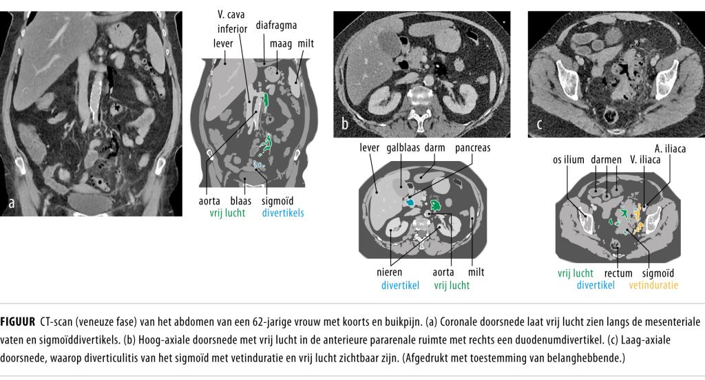 Een vrouw met buikpijn en retroperitoneaal vrij lucht | NTvG