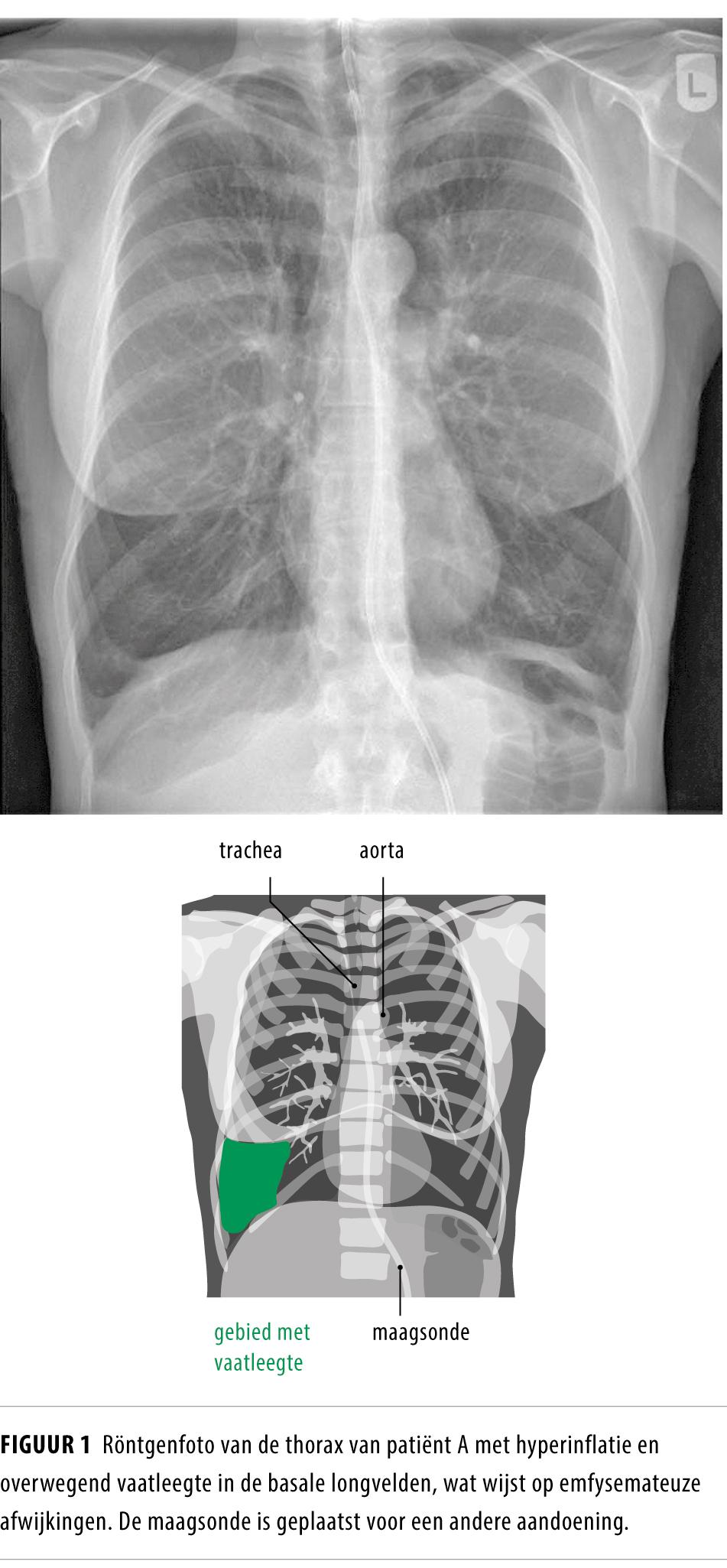 Twee zussen met longemfyseem | NTvG