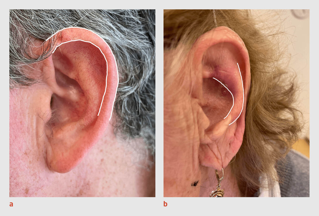 Chondrodermatitis nodularis helicis | NTVG