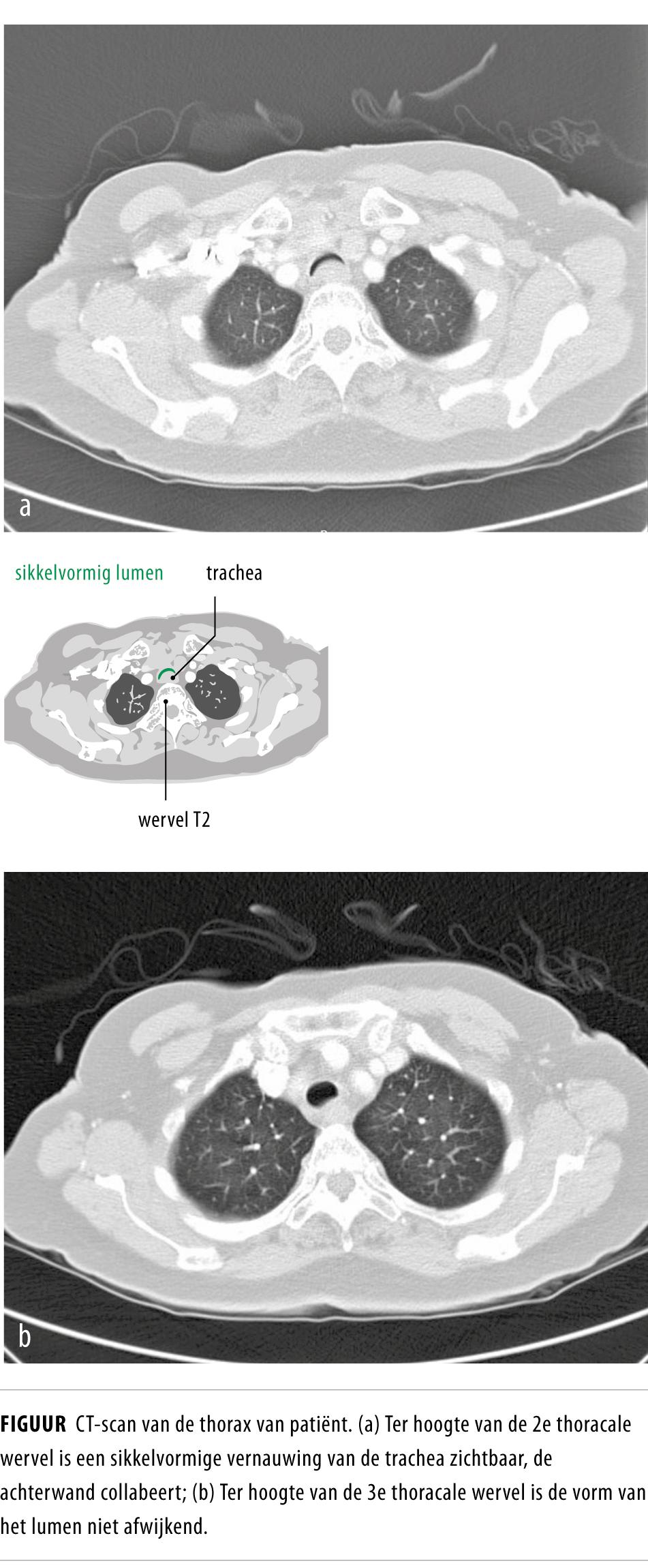 Een vrouw met ‘excessive dynamic airway collapse’ | NTvG