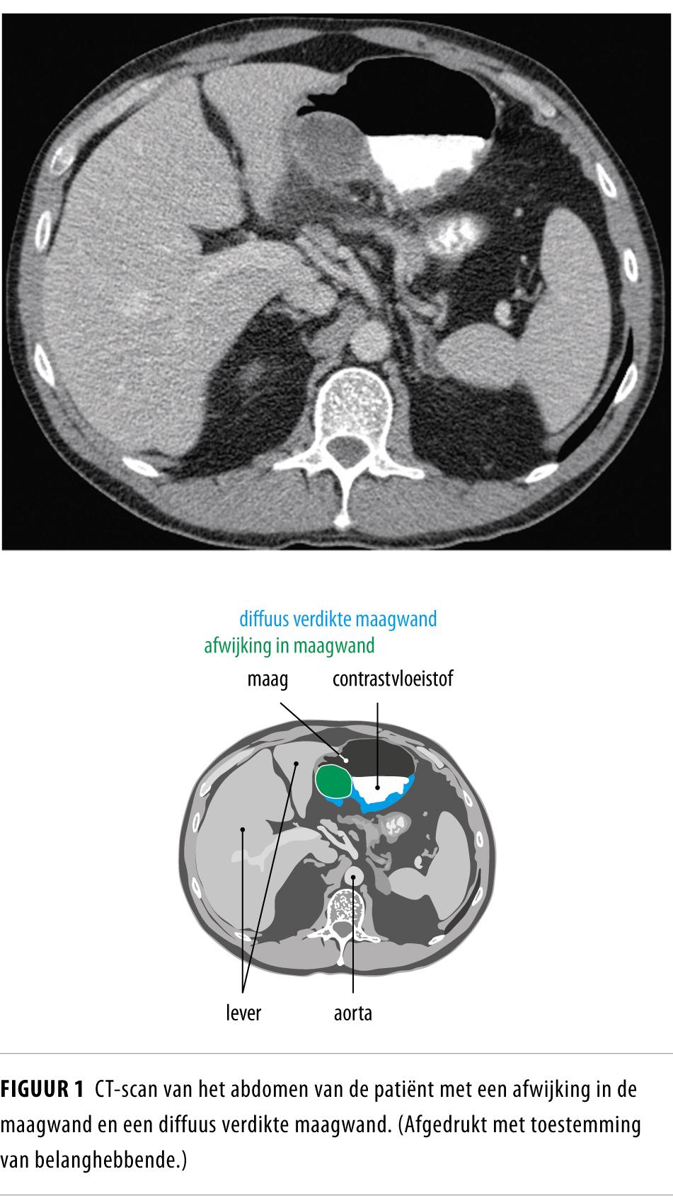 Epigastrische pijn door een maagwandabces | NTvG
