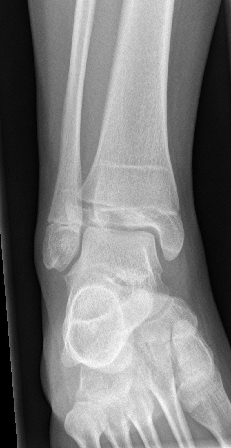 Een tiener met enkelletsel | NTVG