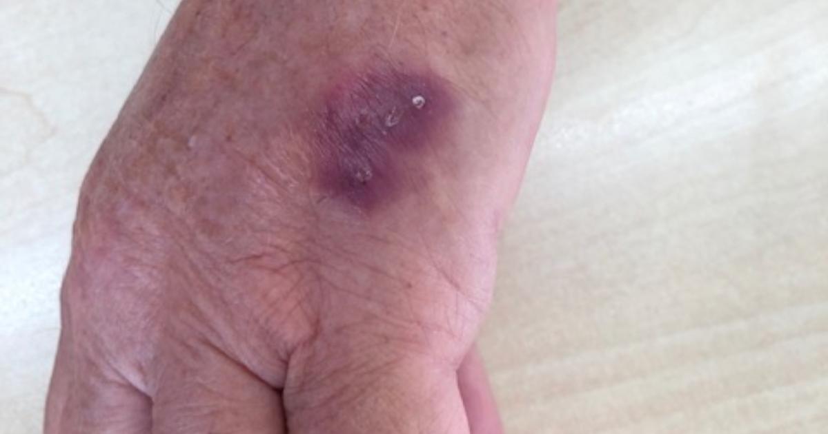 Bijzondere huidafwijking op de handrug | NTVG