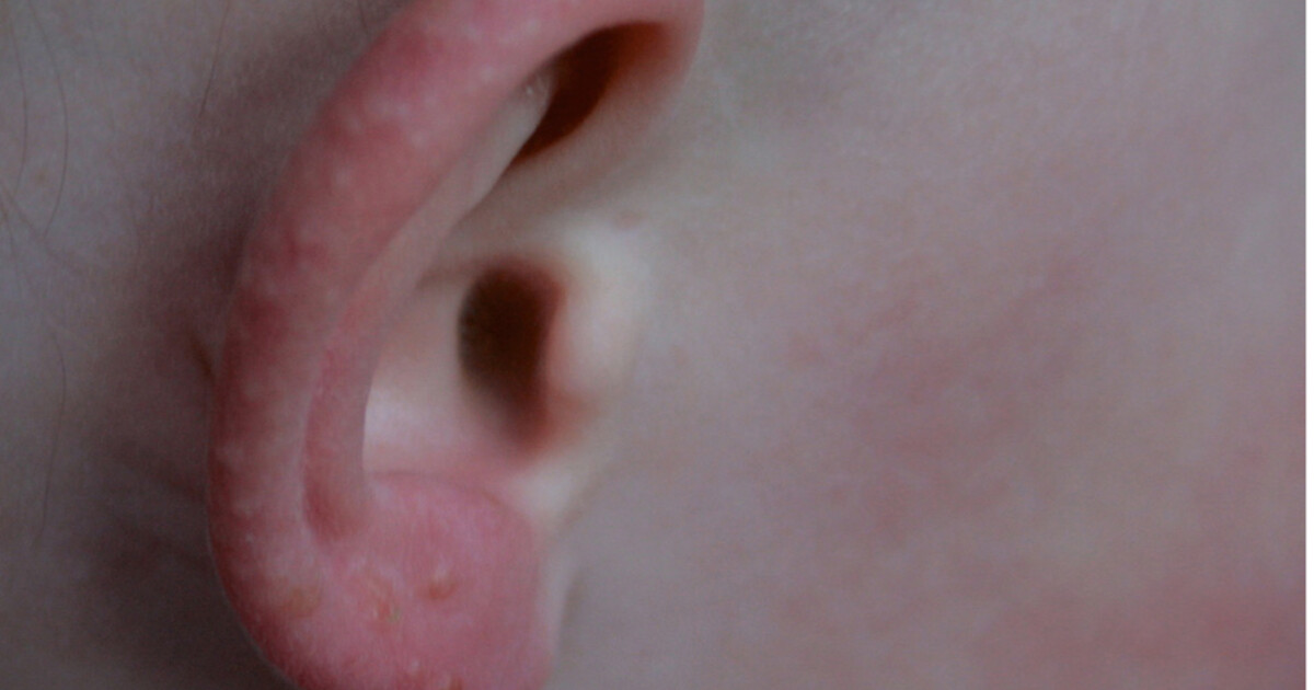 ‘Lente-oren’ (‘juvenile spring eruption’) | NTVG