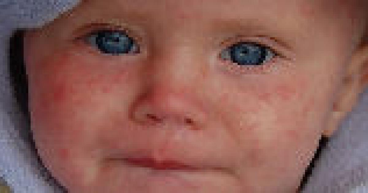 Pasgeborenen onvoldoende beschermd tegen mazelen | NTVG