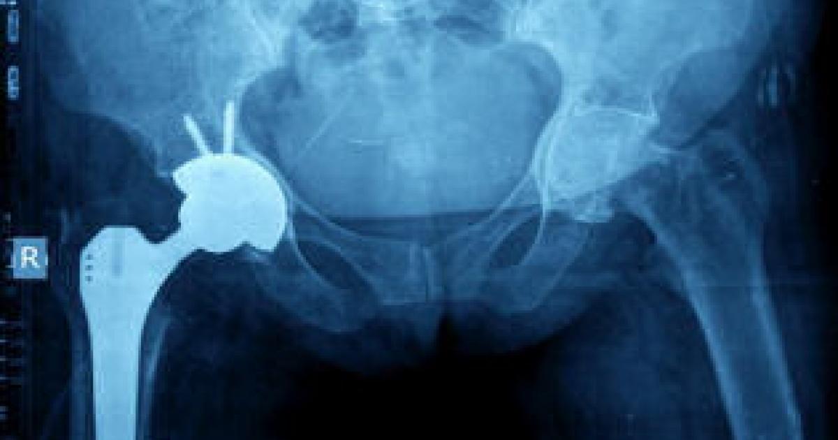 Wat kost een nieuwe heup? | NTVG