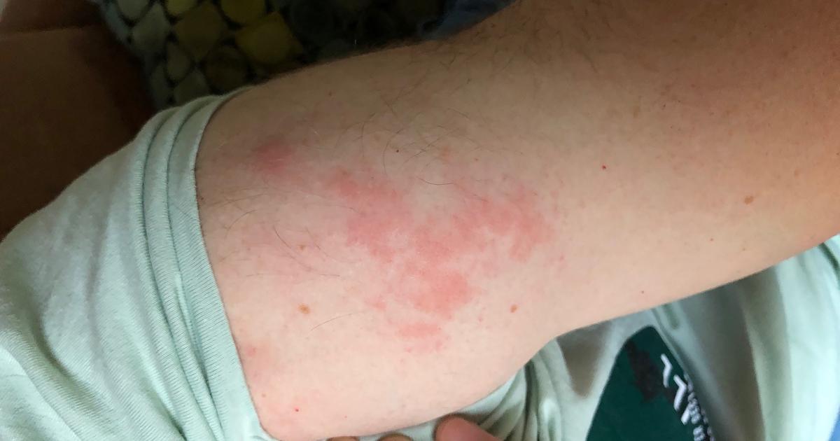 Een rode en gezwollen arm na covid-19-vaccinatie | NTVG