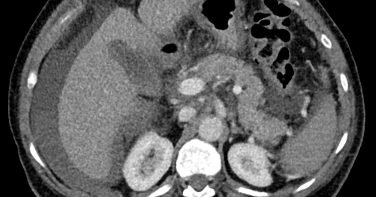 Een patiënte met leverfalen en pseudocirrose | NTVG