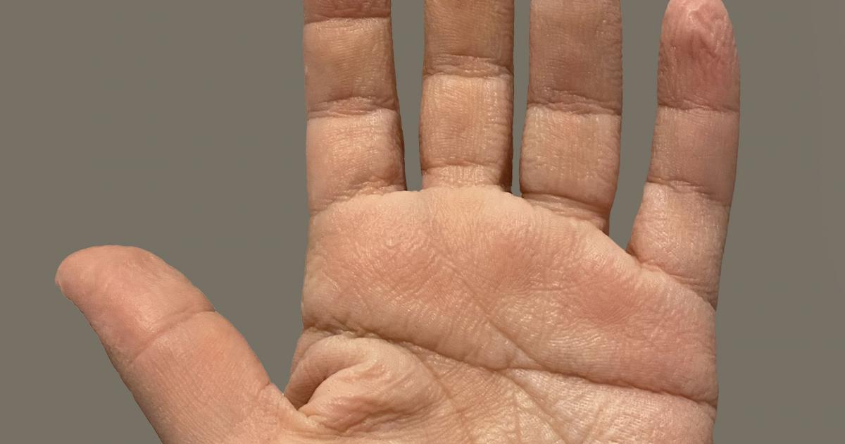 Gerimpelde handpalmen na contact met water | NTVG